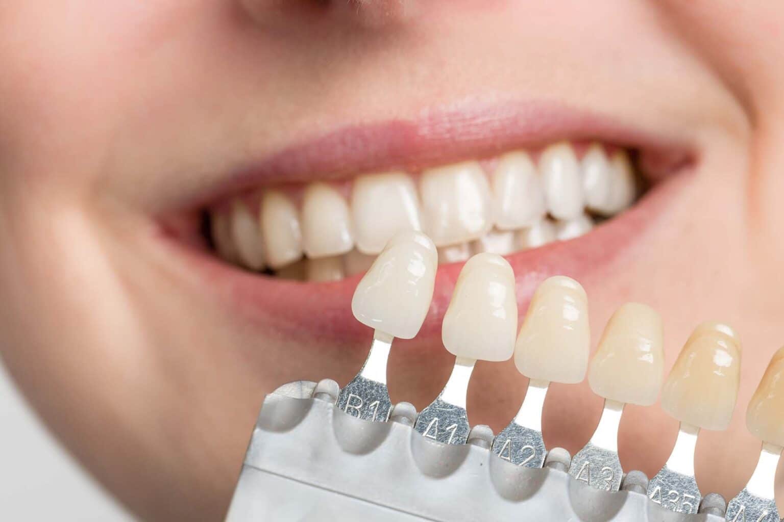 Dental Veneers & Missing Teeth Solutions in Charlotte, NC
